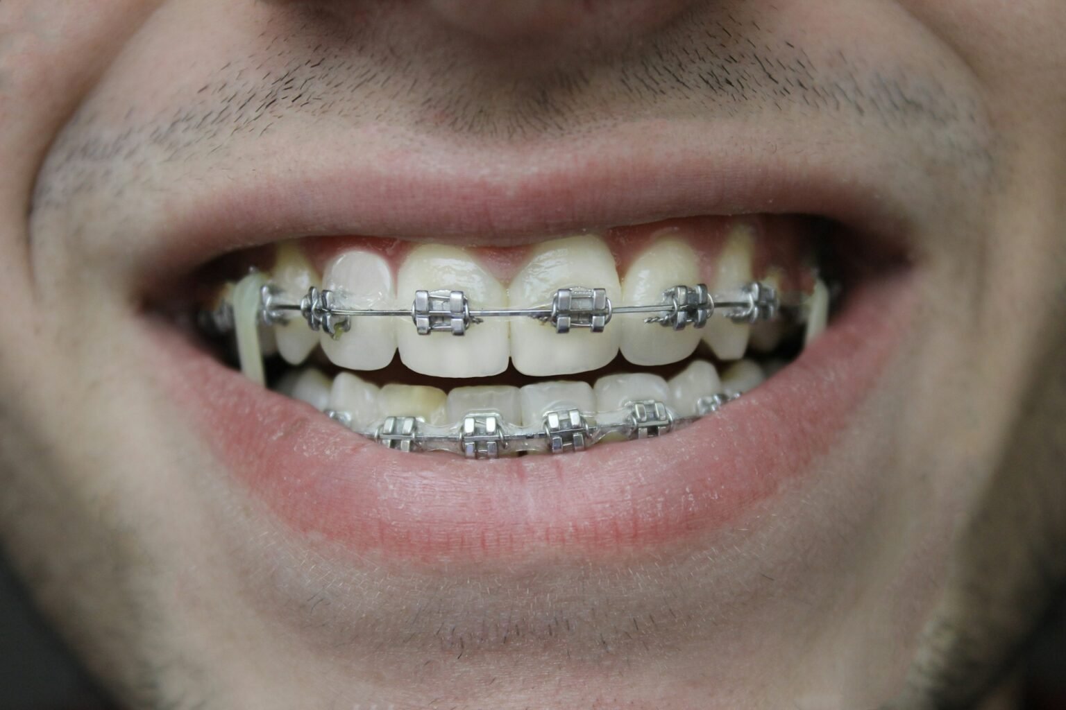 Are Invisible Braces Right For Your Smile Goals? | The Fox Magazine